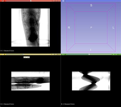 Issues Viewing Dicom Files After Import Support 3d Slicer Community