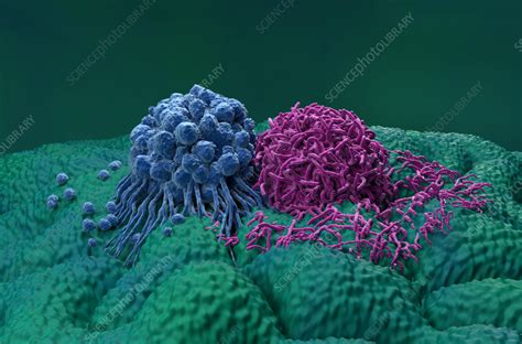 Stomach Cancer Illustration Stock Image F0400841 Science Photo