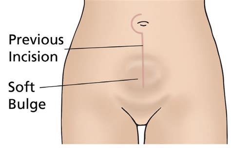 Ultra Radical Surgery For Ovarian Or Primary Peritoneal Cancer Leeds