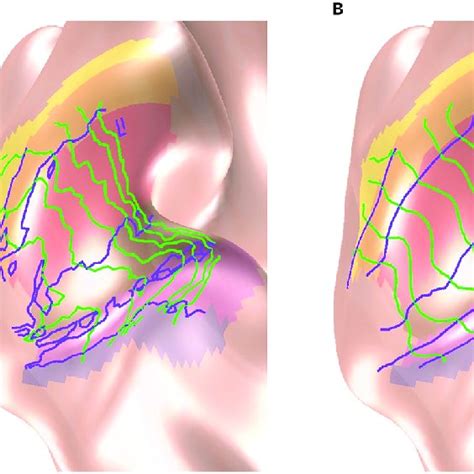 Visual Area Boundary Delineation Of The V1 V3 A Boundaries Inferred