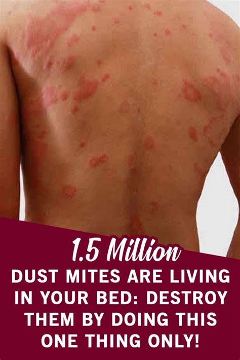 Can Mites Live In Humans At Karen Baptiste Blog