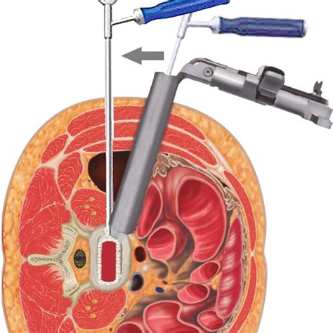 An Intervertebral Fusion Cage Was Inserted A Mallet Was Used To Gently