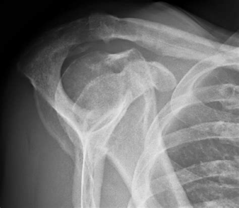 Reconstruction Of Chronic Acromioclavicular Dislocation With