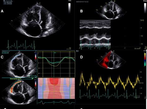 Visual Assessment Of Right Ventricular Function By Echocardiography How Good Are We Springerlink