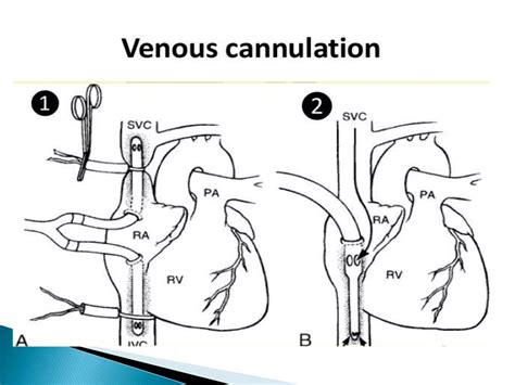 Cannulation And Cardiopulmonary Bypass Pptx