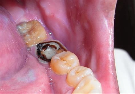 蛀牙的种类有哪些？南京康贝佳口腔医院市医保定点