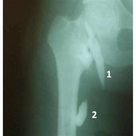 The Spread Of Contrast In Combined Continuous Femoral And Sciatic Nerve Download Scientific