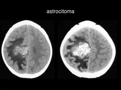 Ppt Tumores Do Sistema Nervoso Central Em Pediatria Powerpoint