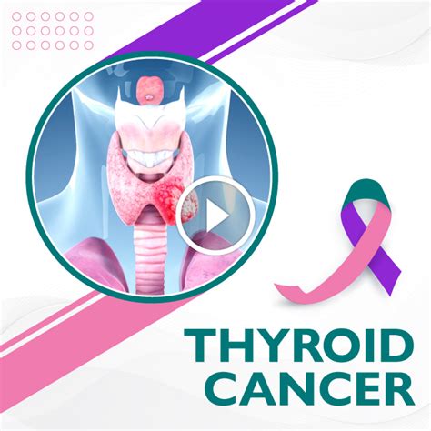 Thyroid Cancer Signs And Symptoms Uhapo