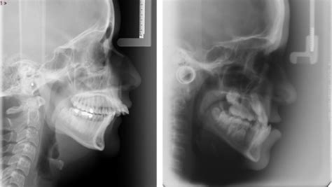 Lateral Cephalometrics In Orthodontics Flashcards Quizlet