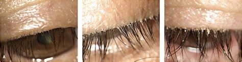 Blepharitis Know When Demodex Is The Culprit Corneal Physician