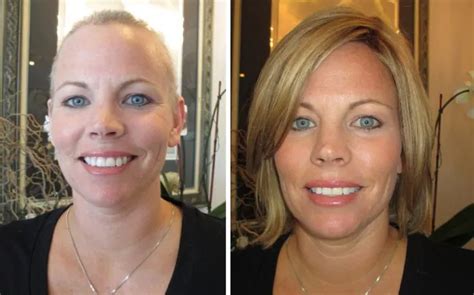 Cranial Prosthesis Before After Photos Newport Hair Loss Center