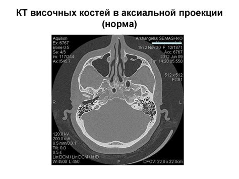 Патология уха Острый средний отит презентация онлайн