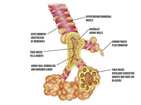 Acute Bronchiolitis