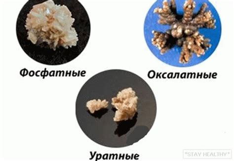 Виды камней в почках фото и описание плотность и способы лечения