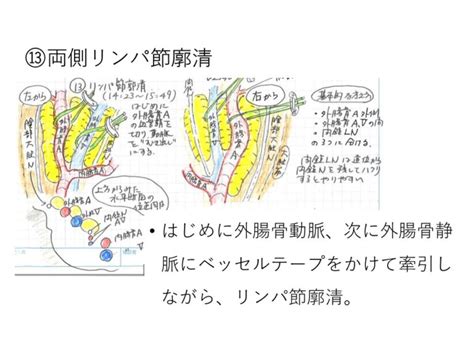 ロボット支援腹腔鏡下膀胱全摘除（rarc回腸導管造設術 泌尿器科医 澤田のブログ
