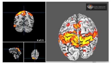 Resting State Fmri