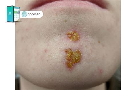 Bệnh Chốc Lở ở Người Lớn Dấu Hiệu Và Cách điều Trị Doctor Có Sẵn