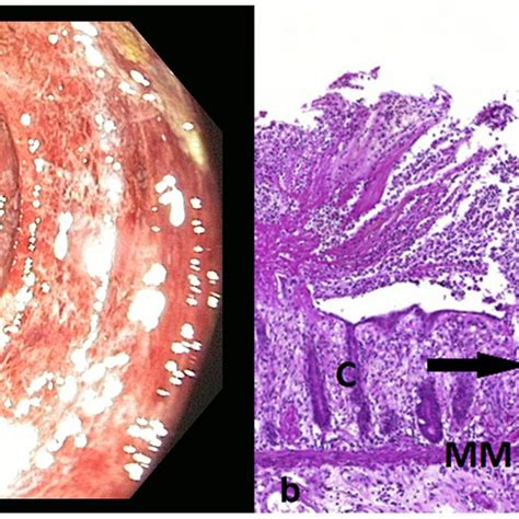 Typical Ultrasound Image In EHEC O104 Infection Left Sided Colitis Download Scientific Diagram