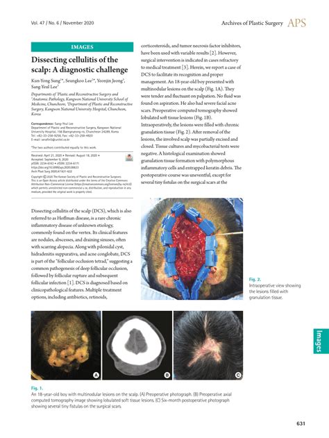 Pdf Dissecting Cellulitis Of The Scalp A Diagnostic Challenge