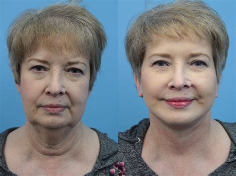 Facelift Before And After Pictures Case 383 West Des Moines And Ames