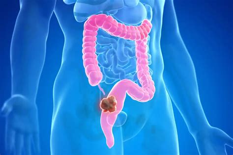 Best Colon Cancer Surgery In Nagercoil Kanyakumari Colectomy Surgery