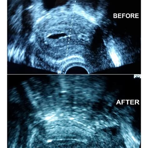 Pdf Aspiration Of Endometrial Cavity Fluid At The Time Of Egg Collection