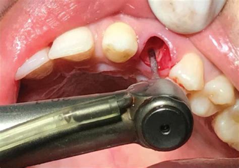 Apical And Palatal Preparation Of The Osteotomy Site Download