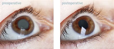 Cataracts Ophthalmology Optometry And Eye Surgery