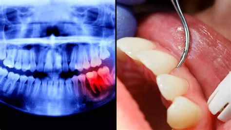 Warning Signs You Have ‘irreversible Disease In Your Mouth Health