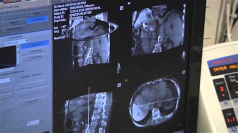 Drug Eluting Bead Chemoembolization Deb Tace For Liver Cancer Youtube