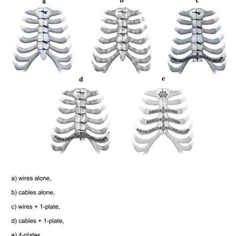 Pdf Sternal Plating For Primary And Secondary Sternal Closure Can It