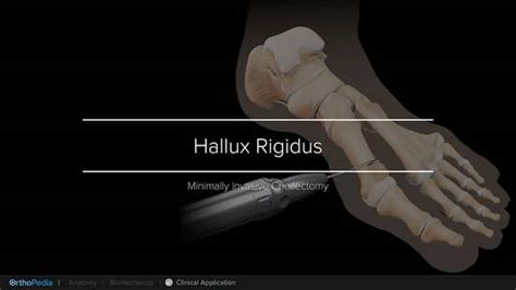 Hallux Rigidus Treatment With A Minimally Invasive Cheilectomy