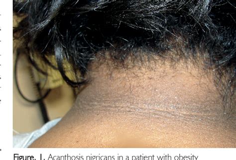 Figure 1 From Acanthosis Nigricans A Common Significant Disorder