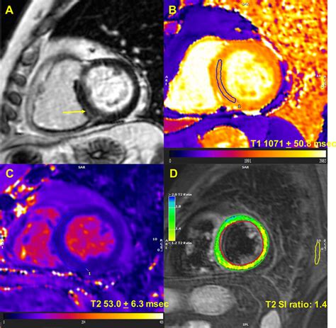Cardiac Magnetic Resonance Of Scleroderma Patient With Cardiac
