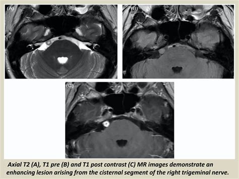 Presentation1 Radiological Imaging Of Trigeminal Schwanoma Pptx