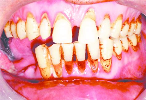 Four Months Postoperative Without Prosthesis Fig 6 Guide Flange