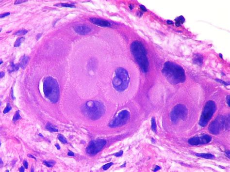 Carcinoma Spinocellulare Doccheck