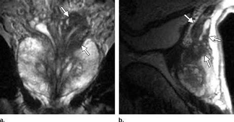 Prostate Cancer In A 64 Year Old Man With A Prostatectomy Gleason Score