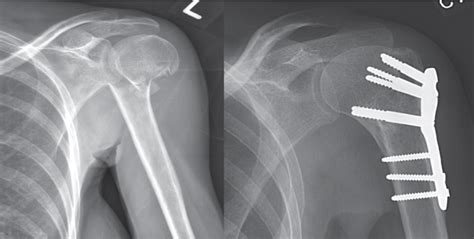 Figure 1 From Functional Outcome After Proximal Humerus Fracture
