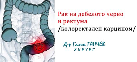 Д р Галин ГАНЧЕВ хирург Рак на дебелото черво и ректума
