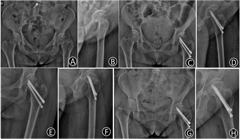 A 65‐year‐old Female Patient Had The Femoral Head Necrosis After Download Scientific Diagram