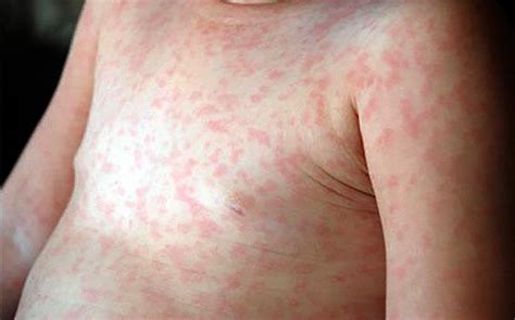 Abi Declaran Alerta Epidemiológica Nacional Por Nuevo Caso Positivo