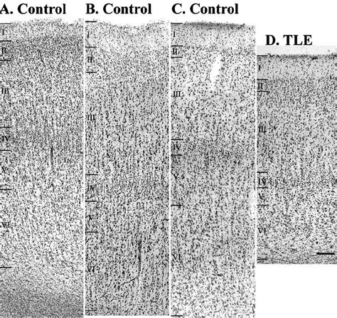 Photomicrographs Of Layers I Vi Of Temporal Neocortex In Controls Ac Download Scientific