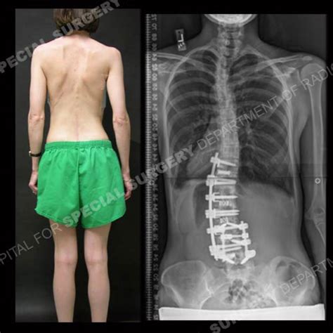 Lumbar Scoliosis Surgery