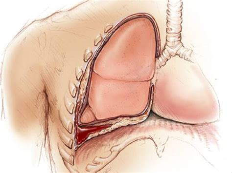 胸膜间皮瘤的预后转归与护理要点患者