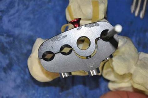 Stepwise Approach To Uniplane Biplane Delta And Hybrid External