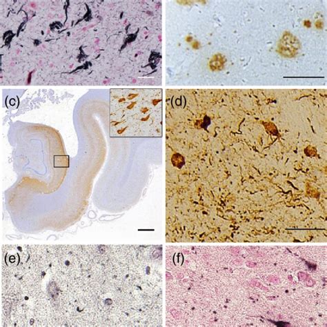 Lewy Body Lb Pathology Lbs Are Eosinophilic Intraneuronal Inclusions