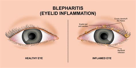 The Best Treatment Options For Managing Demodex Blepharitis