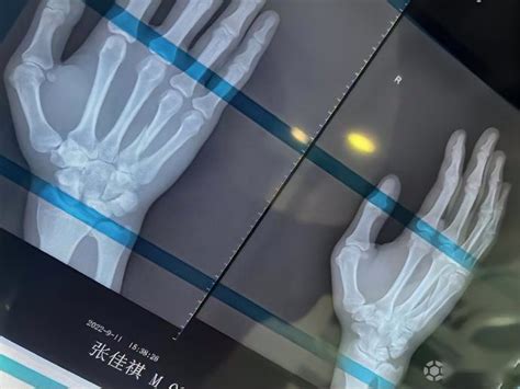 浙江队官方：张佳祺右手无名指掌骨骨折，带伤踢完昨晚比赛pp视频体育频道